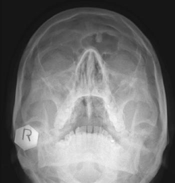 Pneumonologia. 21-letni mężczyzna z przewlekłym kaszlem - Przypadki ...