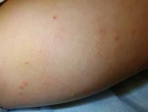 Swędząca osutka u 9-letniej dziewczynki - Pediatria ilustrowana ...