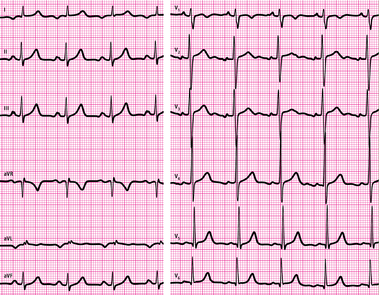 Jaki to rytm (Zagadka 93)? - Zagadki - EKG - Medycyna Praktyczna dla ...