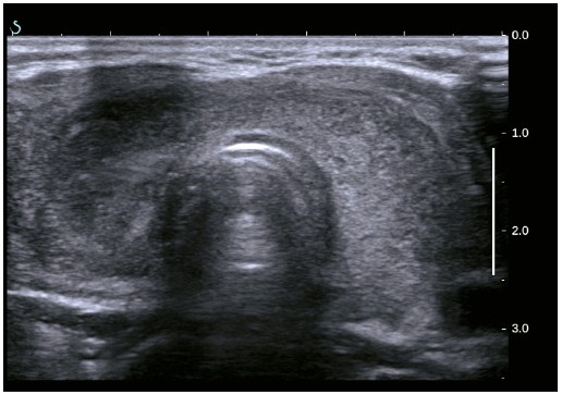Ultrasonografia tarczycy. Cz.14: Wskazania do leczenia operacyjnego w ...