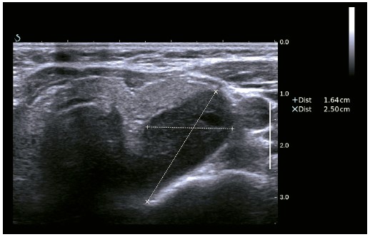 Ultrasonografia tarczycy. Cz.14: Wskazania do leczenia operacyjnego w ...