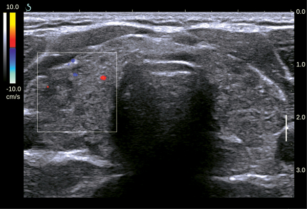 Ultrasonografia tarczycy. Cz. 8: Jatrogenne patologie tarczycy ...