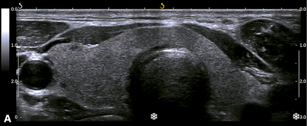 Ultrasonografia tarczycy. Cz. 8: Jatrogenne patologie tarczycy ...