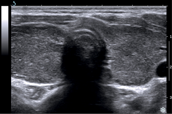Ultrasonografia tarczycy. Cz. 8: Jatrogenne patologie tarczycy ...