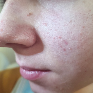 Nieswędząca osutka na stopach - strona 2 - Pediatria ilustrowana ...