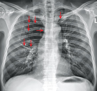 Diagnostyka radiologiczna. 51-letnia kobieta z kaszlem i bólem w klatce ...