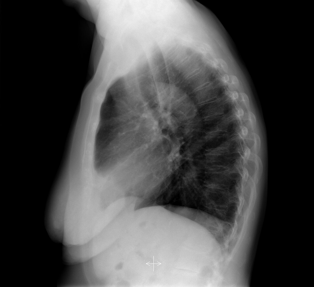Jaka patologia widoczna jest na radiogramie i tomografii? cz. 274 ...