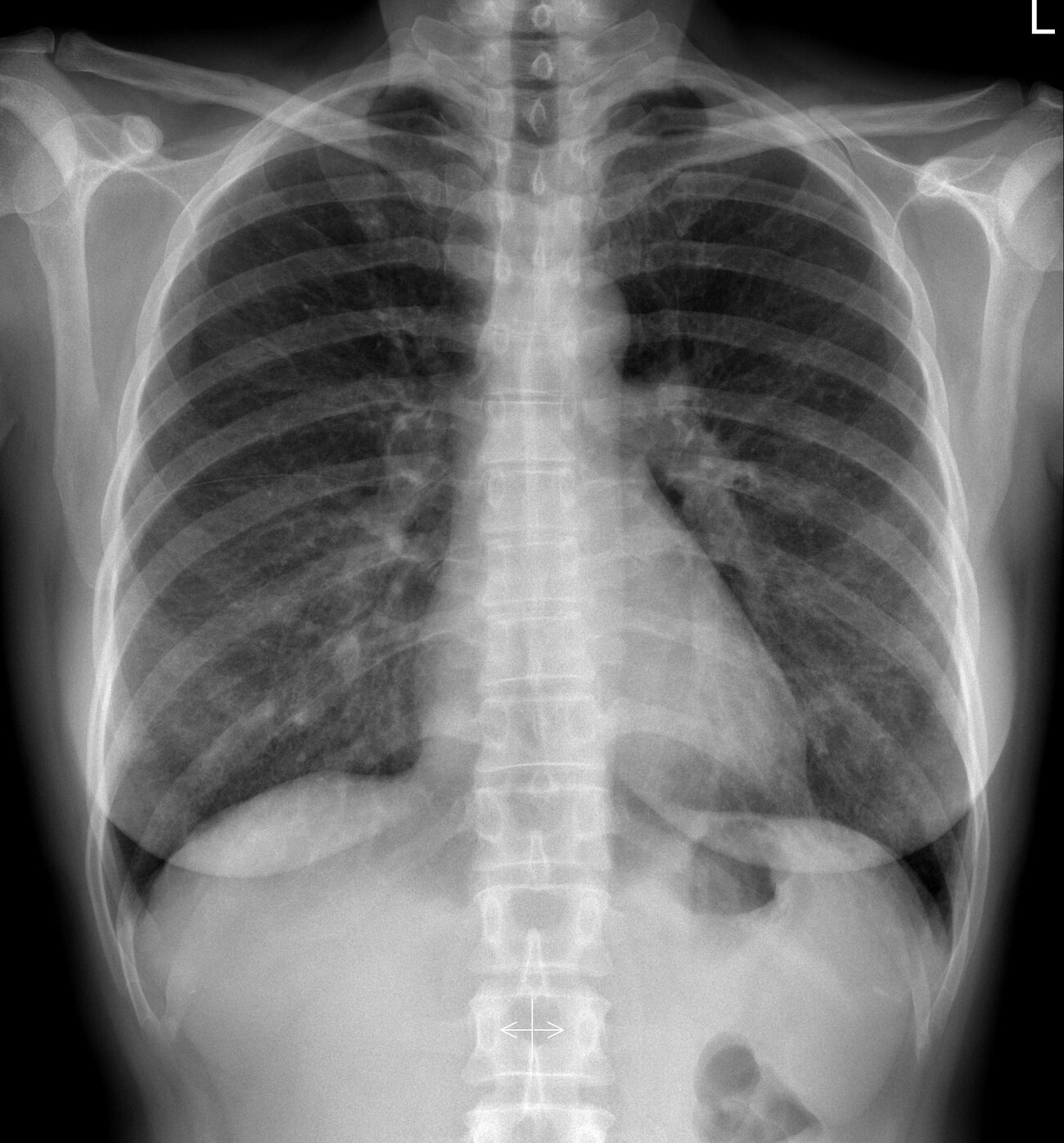 Jaka patologia widoczna jest na radiogramie i tomografii? cz. 300 ...