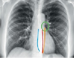 Diagnostyka radiologiczna. 65-letni mężczyzna z guzem szyi - Rak płuca ...