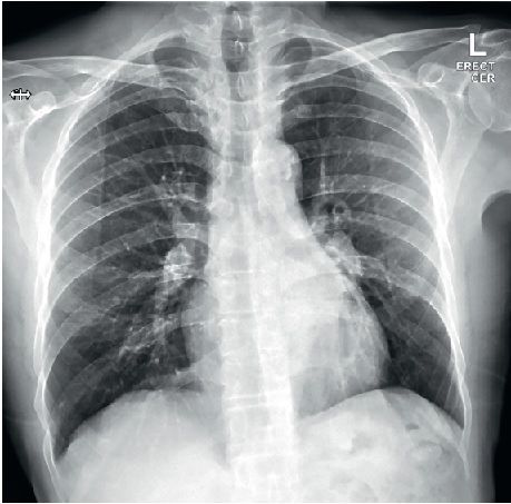Diagnostyka radiologiczna. 65-letni mężczyzna z guzem szyi - Rak płuca ...