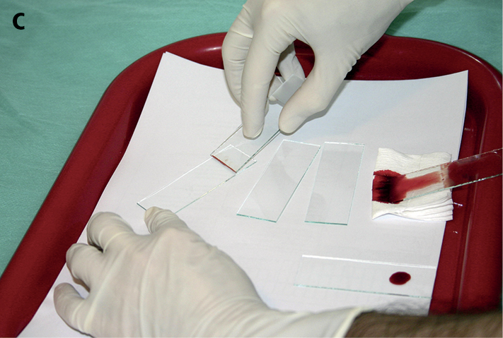 Interna – mały podręcznik - Medycyna Praktyczna: Biopsja szpiku