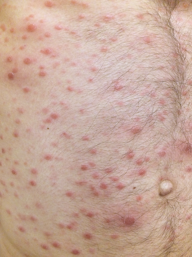Cureus Paediatric Hemophagocytic Lymphohistiocytosis A 57 OFF