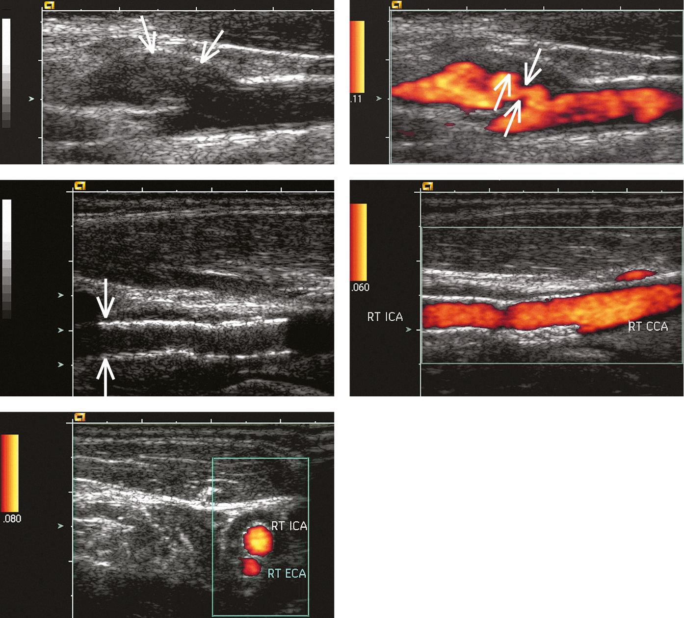 Figure 031 6082 Carotid Ultrasonography A B mode Longitudinal Image