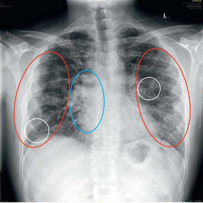 Diagnostyka radiologiczna. 37-letni mężczyzna z dusznością - Radiologia ...